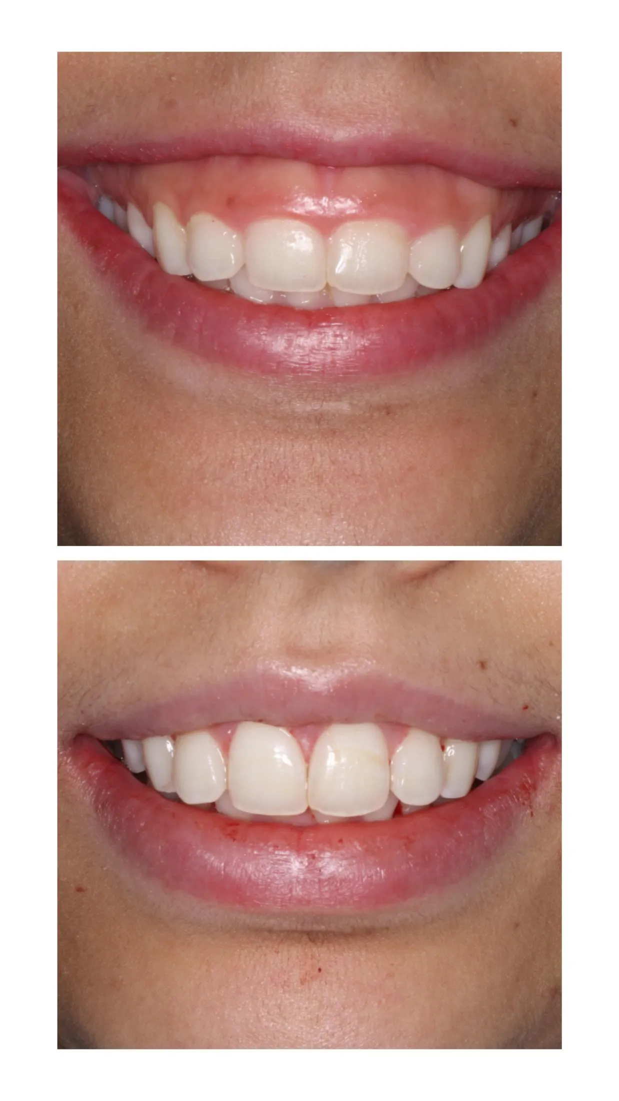 Real Vampire Teeth Implants